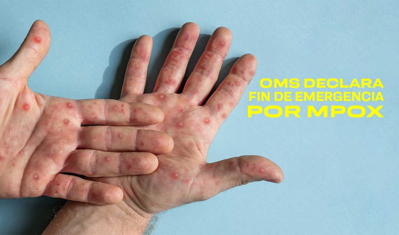 OMS anuncia el fin de la emergencia sanitaria por la viruela símica ...