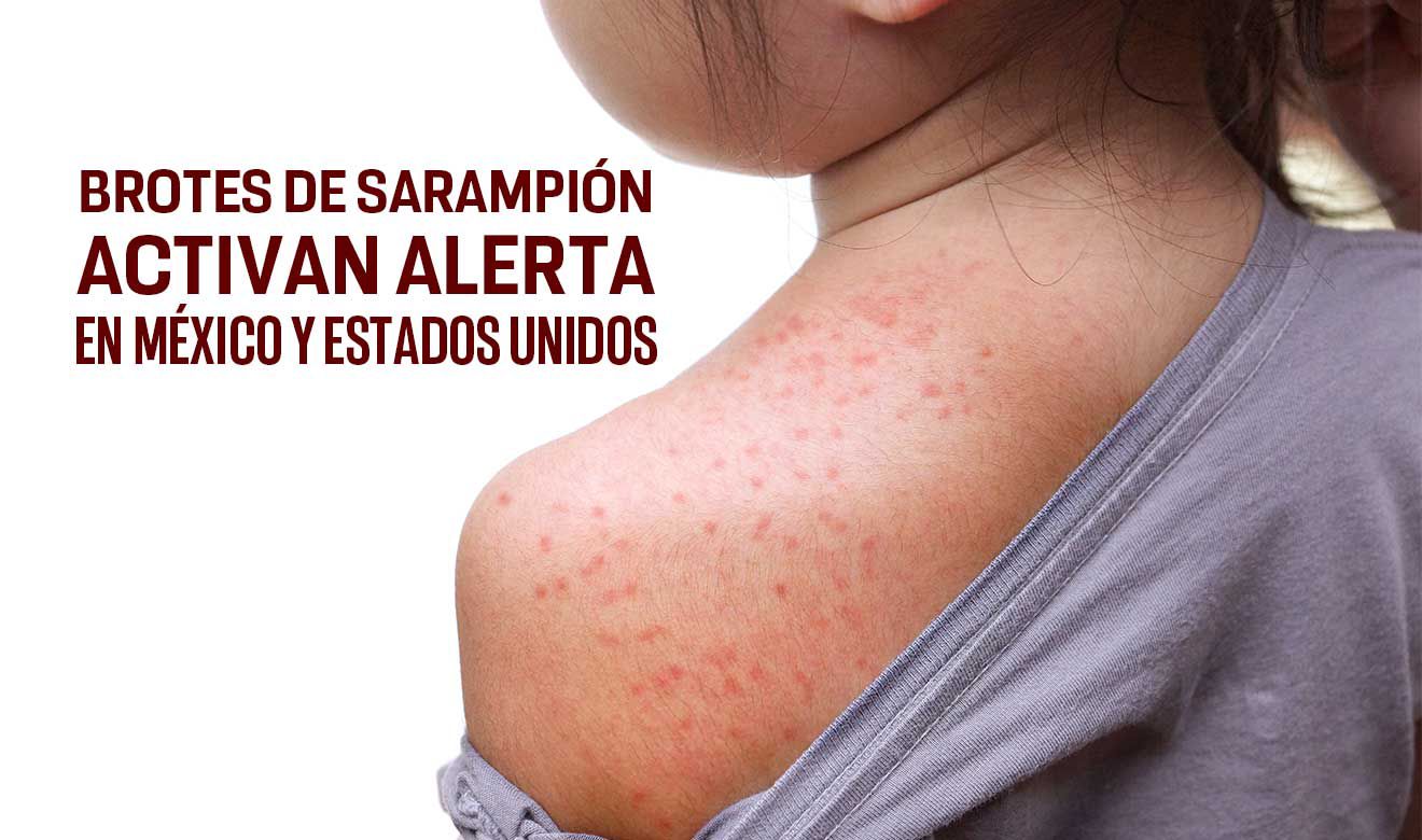 Sarampión en México y Estados Unidos: casos en aumento - UNAM Global